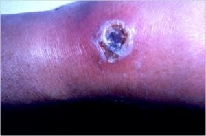 Anthrax Images | Immunize.org