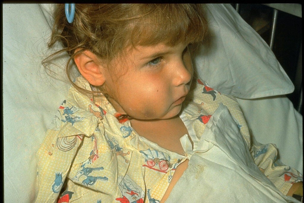 Hib (Haemophilus Influenzae Type B) Images | Immunize.org