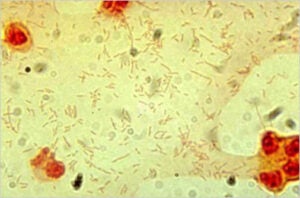 Hib (Haemophilus Influenzae Type B) Images | Immunize.org
