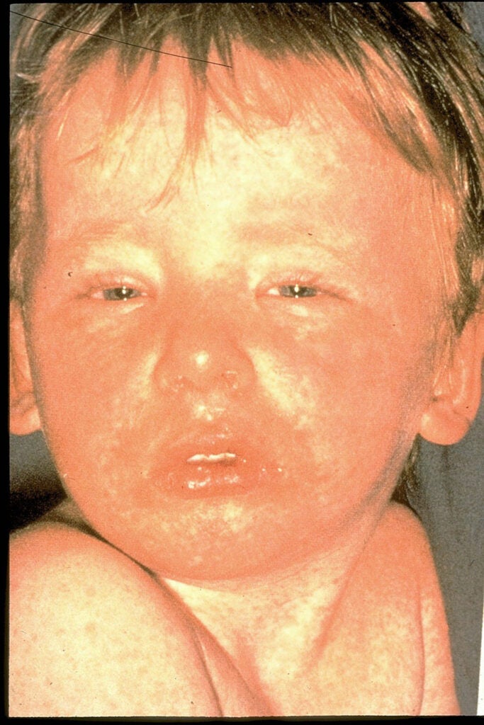 Measles Images | Immunize.org