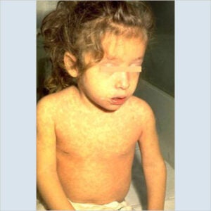 Measles Images | Immunize.org