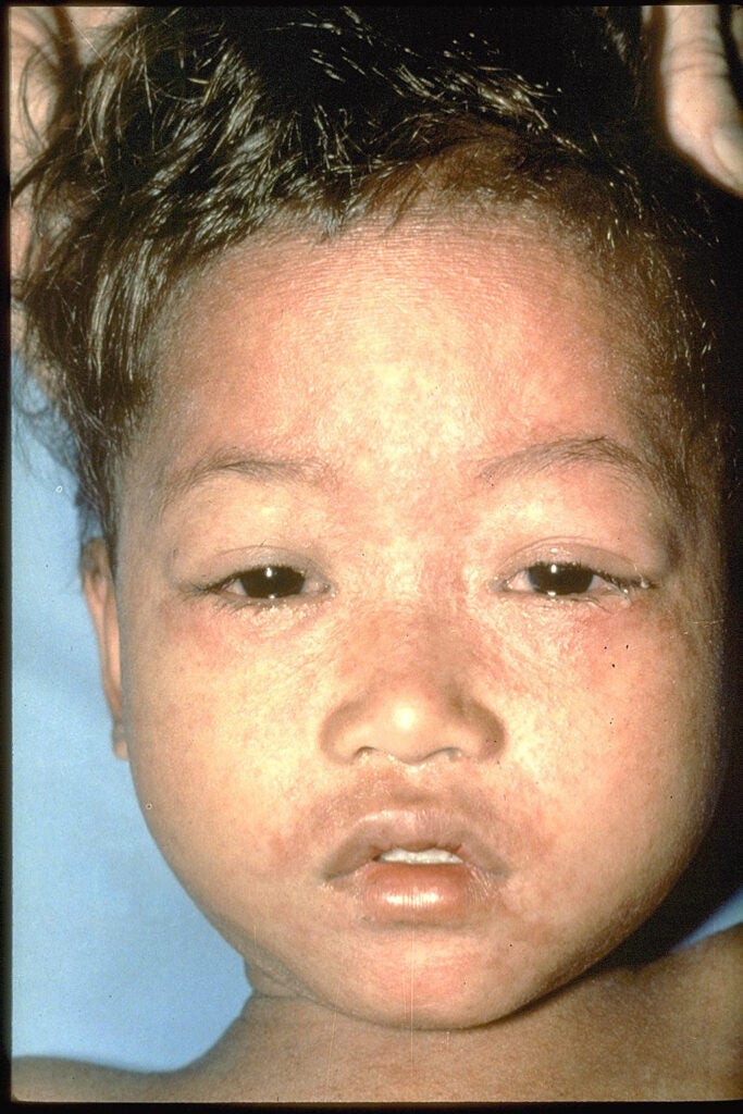 Measles Images | Immunize.org