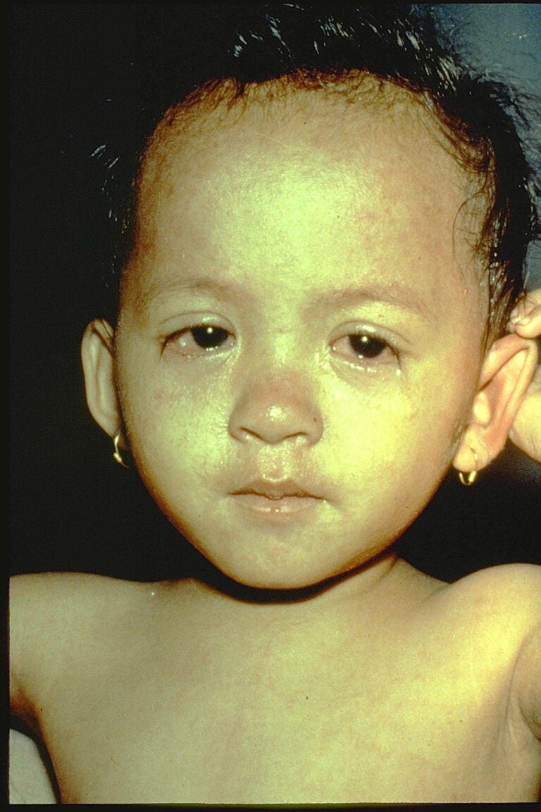 Measles Images | Immunize.org