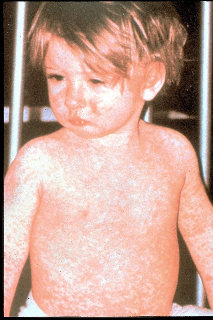 Measles Images | Immunize.org