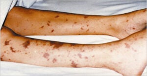 Meningococcal Images | Immunize.org