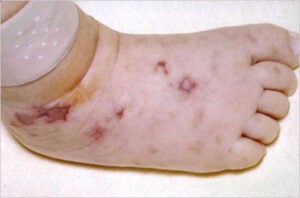 Meningococcal Images | Immunize.org