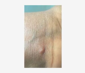 Mpox Images | Immunize.org