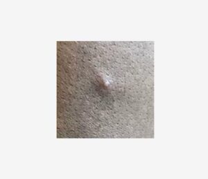 Mpox Images | Immunize.org