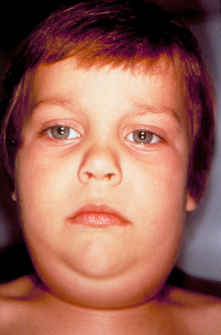 Mumps Images | Immunize.org