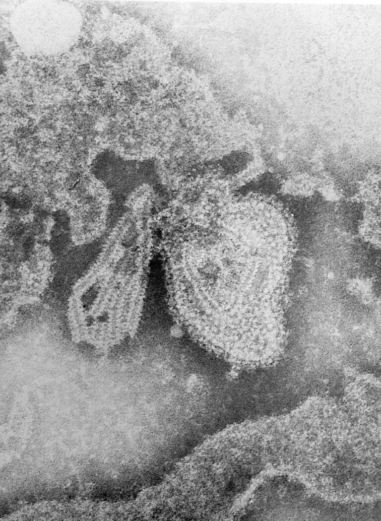 Mumps Images | Immunize.org
