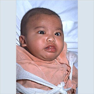 Pertussis Images | Immunize.org