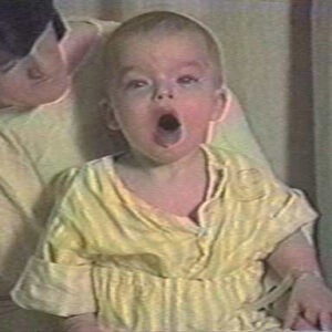 Pertussis Images | Immunize.org