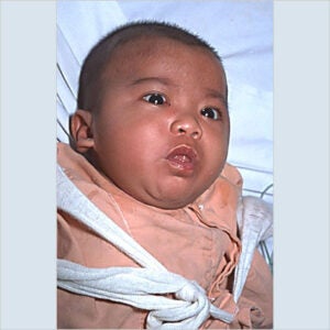 Pertussis Images | Immunize.org