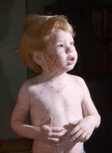 Rubella Images | Immunize.org