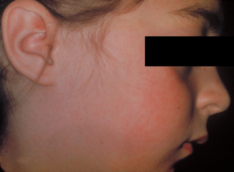 Rubella Images | Immunize.org