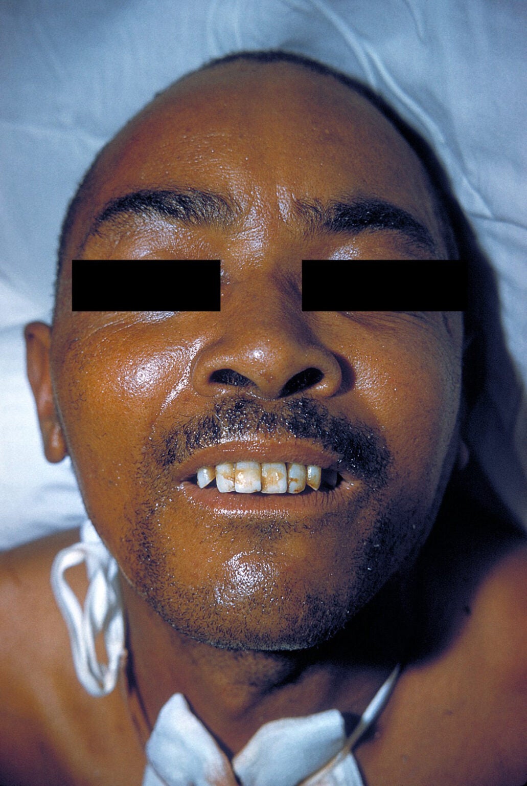 Tetanus Images | Immunize.org