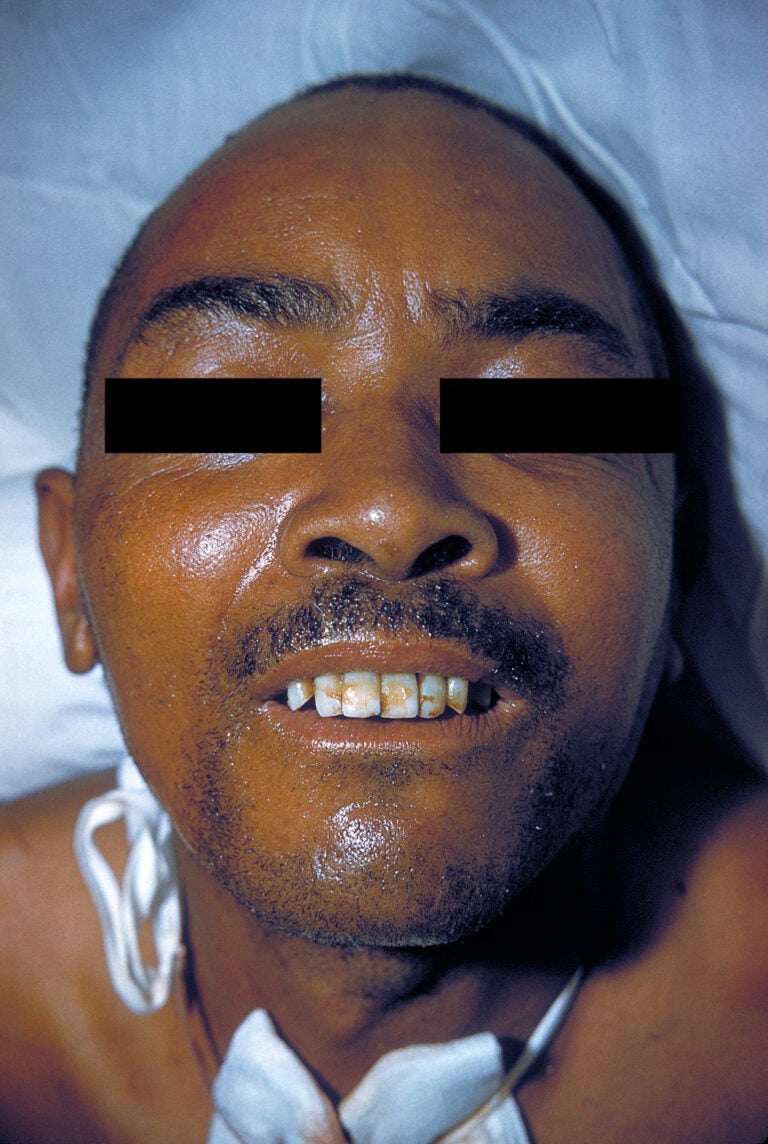 Tetanus Images | Immunize.org