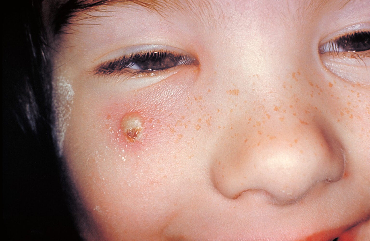 Varicella (Chickenpox) Images | Immunize.org
