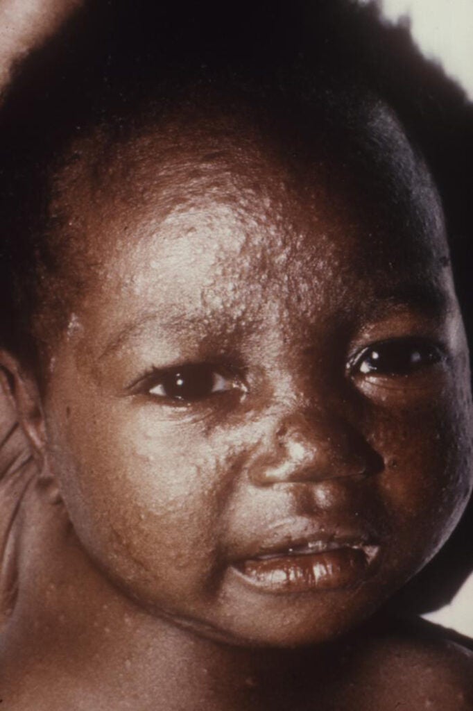Varicella (Chickenpox) Images | Immunize.org