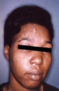 Zoster (Shingles) Images | Immunize.org
