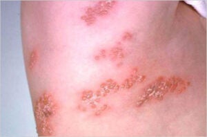 Zoster (Shingles) Images | Immunize.org