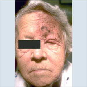 Zoster (Shingles) Images | Immunize.org