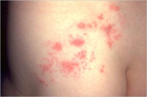 Zoster (Shingles) Images | Immunize.org
